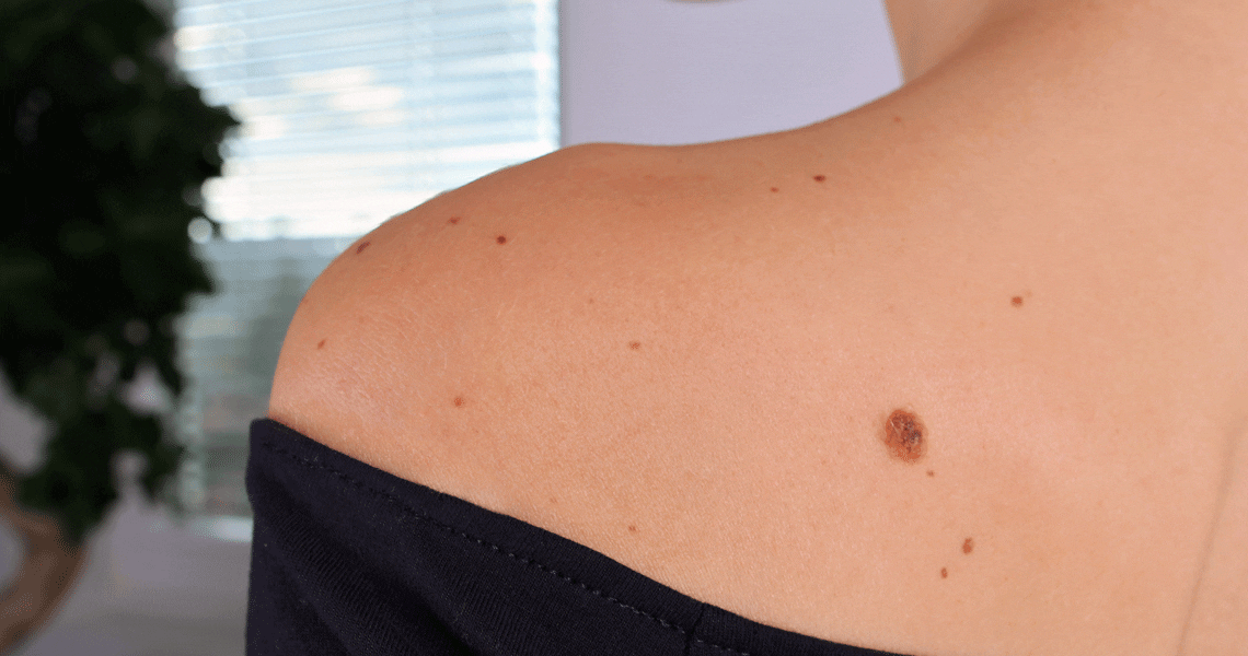 Mole Watch - Alberta Cancer Foundation